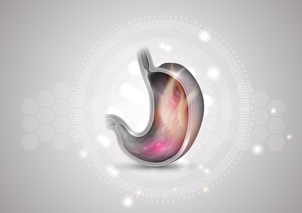 Understanding GERD Beyond Heartburn | Lifecare Hospital